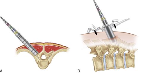 Minimally Invasive Thoracic Corpectomy Neupsy Key