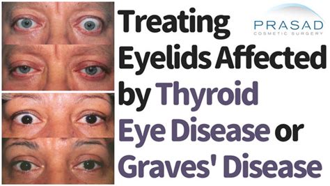 Thyroid Eye Disease How To Fix Retracted Eyelids And Restore Comfort