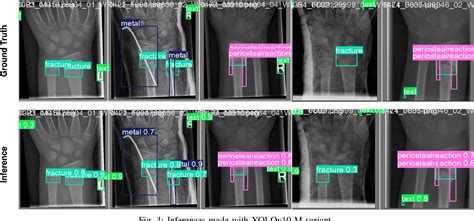 Pediatric Wrist Fracture Detection In X Rays Via Yolov10 Algorithm And Dual Label Assignment System