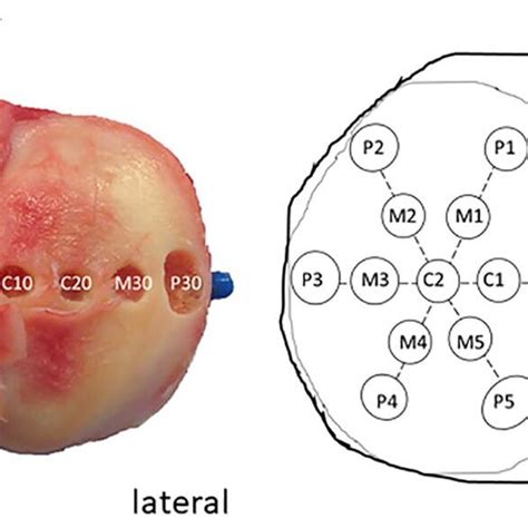 Systematic Placement Of Biopsy Locations Across The Tibia Plateau