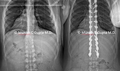 Severe Congenital Kyphoscoliosis Pediatric Munish C Gupta M D