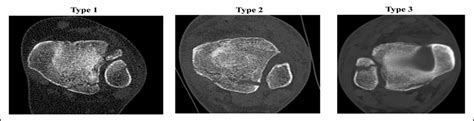 Posterior Malleolar Fracture Assessment An Independent Inte Jaaos