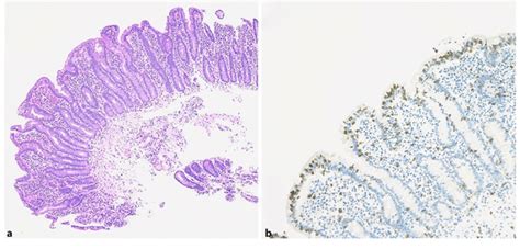 A Histology Image Showing The Duodenum Prior To Gluten Free Nutrition