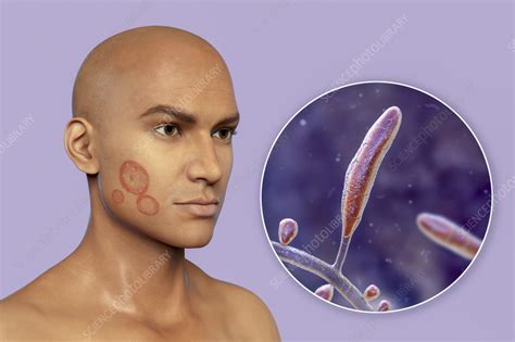 Ringworm Illustration Stock Image F036 4500 Science Photo Library