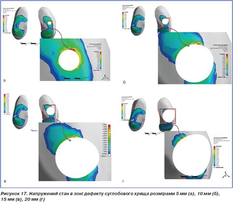 Математичне моделювання з визначенням напружено деформованого стану в тібіофеморальній зоні в
