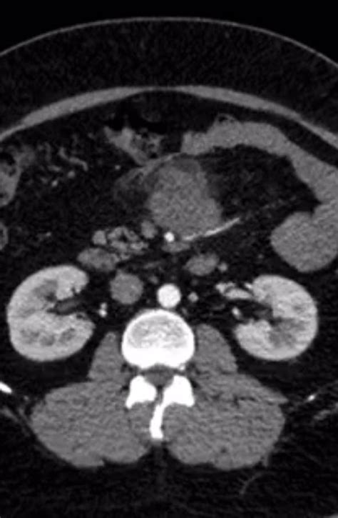 Laparoscopic Minimally Invasive Surgery For Mesenteric Tumor Lpc Mumbai