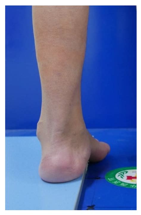 Evaluation And Management Of Cavus Foot In Adults A Narrative Review