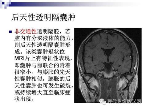 什么时候报透明隔间腔增宽 医学界 助力医生临床决策和职业成长