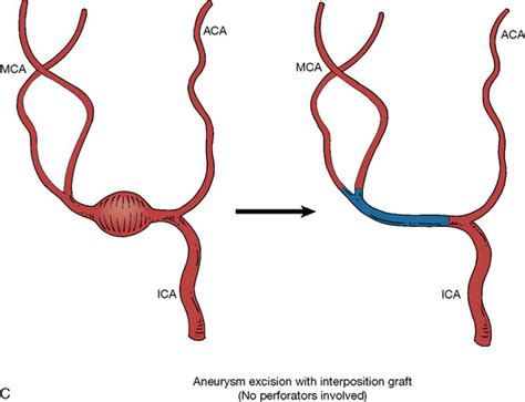 Bypass Surgery For Complex Mca Aneurysms Neupsy Key