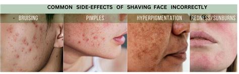Causes Of Hyperpigmentation After Shaving Upper Lips Hair Fai