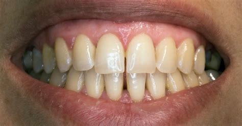 누런 치아 고민 음식·담배 말고 다른 원인은