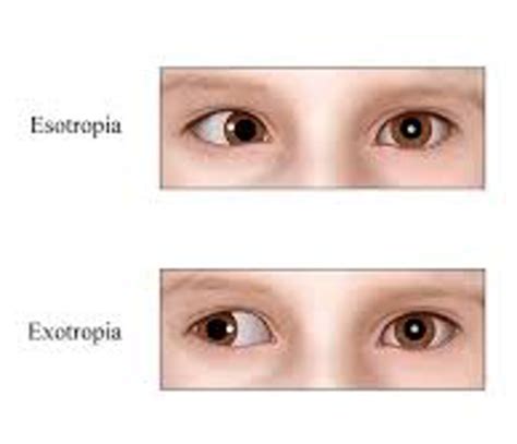 Adult Intervention Visual Perceptual Dysfunction Flashcards Quizlet