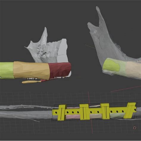 Virtual 3d Planning For A Osteocutaneous Fibula Graft Using A Download Scientific Diagram