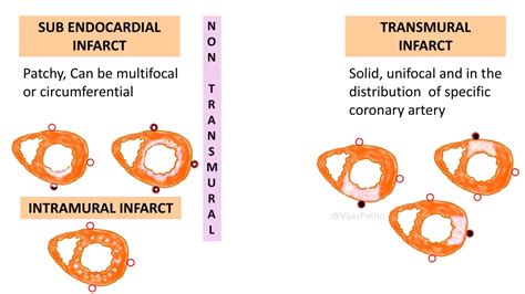 Myocardial Infarction Pathogenesis And Infarct Types Pathology Made