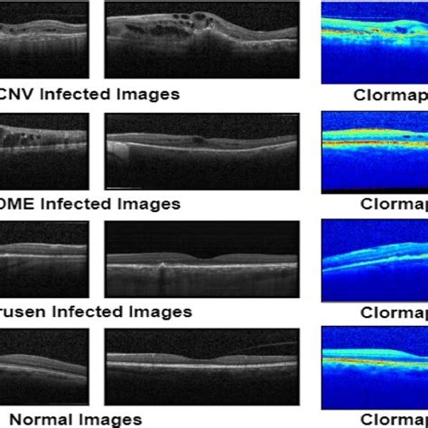 Bar Graph Comparison Of Different Ml Algorithms Used For Retinal Eye