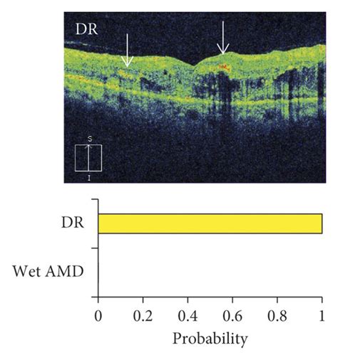 The Identification Of Diabetic Retinopathy Dr Vs Wet Age Related Download Scientific Diagram