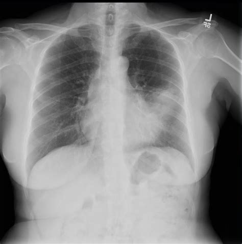 290lu Hamartoma With Superior Lingula Segmental Atelectasis Lungs 290lu Hamartoma With Superior Lingula Segmental Atelectasis Lungs
