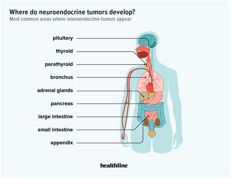 Neuroendocrine Tumors Location Causes Treatment Outlook