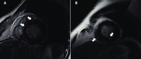 A Cardiac Magnetic Resonance Imaging Mri Scan Showing Subepicardial Download Scientific