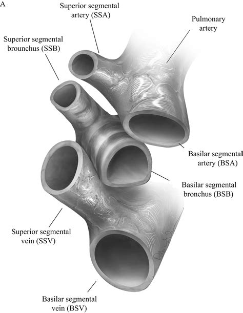 Video Assisted Thoracoscopic Segmentectomy Of The Lower Lobe Superior And Basilar Segmentectomy