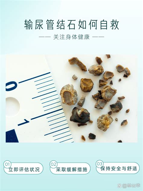 输尿管结石痛到生不如死，如何自救