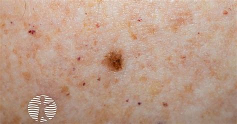 Superficial Spreading Melanoma Image Superficial Spreading Melanoma Image