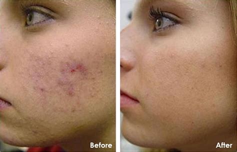Home Yuva Medical Spa Acne Is Normal Photoshop Double Chin Photo