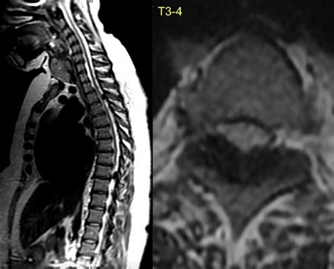 Thoracic Spinal Stenosis From Calcified Ligamentum Flavum Ochsner Journal