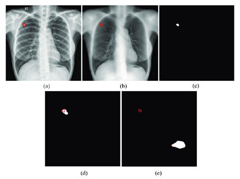 Tb Consistent Lesion Segmentation Performance Using The U Net With Download Scientific Diagram