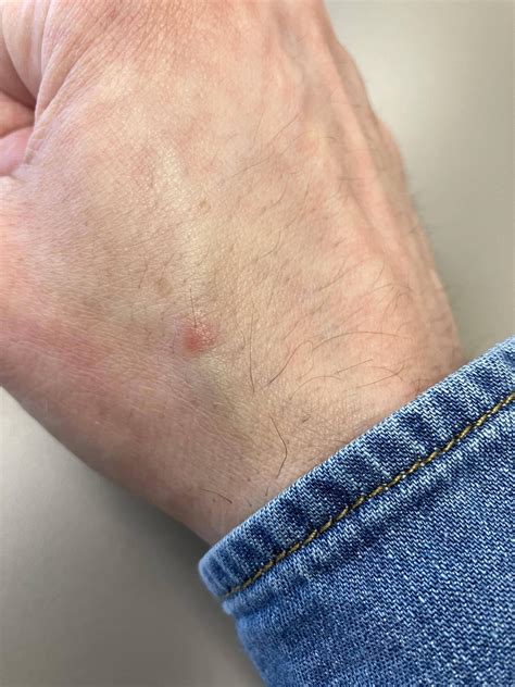 Bedbug Bite R Bugbites