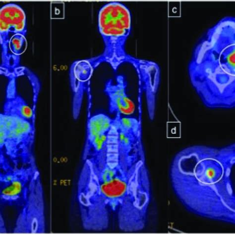 A And B Show Ct Guided Biopsy Of The Anterior Glenoid Lesion With