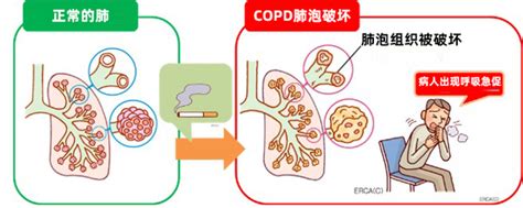 一文细说肺气肿病因症状治疗和预防 知乎