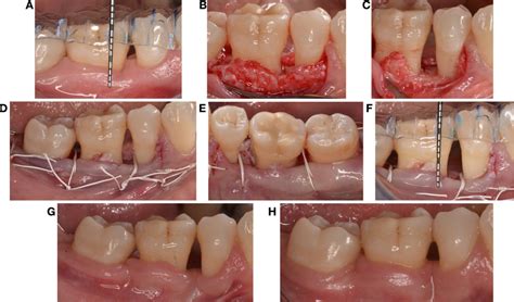 Wound Healing And Soft Tissue Regrowth In A Sextant Treated With
