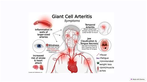 Giant Cell Arteritis A Comprehensive Overviewpptx