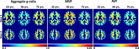 Aggregate G‐ratio Mvf And Avf Maps Derived From The Brains Of Three