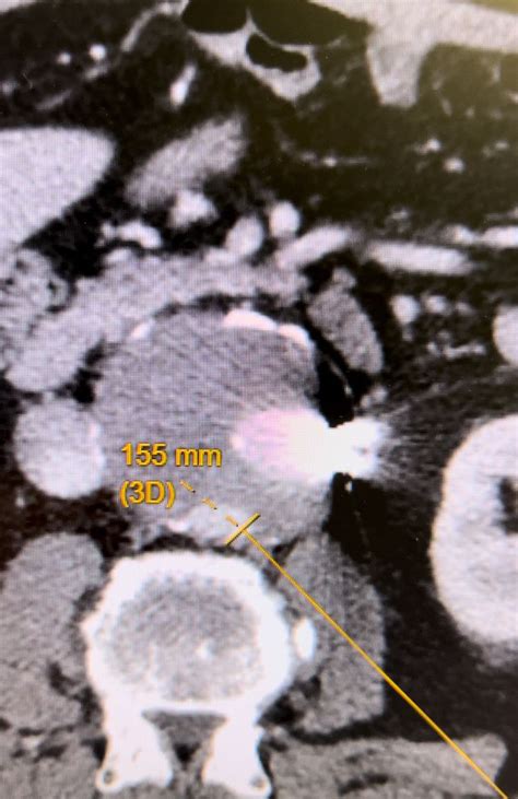 Ct Guided Treatment Of Typeii Endoleak With Onyx Direct Injection Via