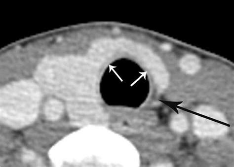 A 42 Year Old Woman With Left Thyroid Hemiagenesis Case 1 Axial