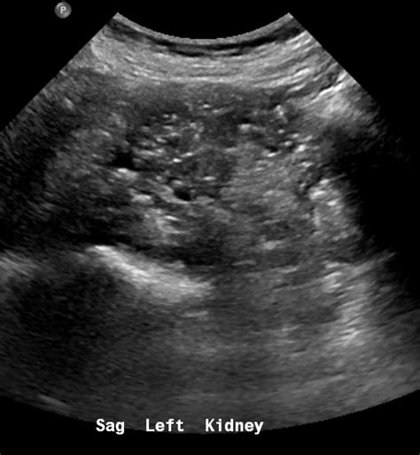 Faces Of Calcifications The Common Vein