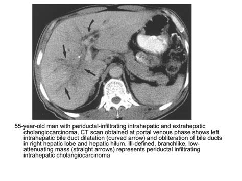 Diagnostic Imaging Of Cholangiocarcinoma PPT Digestive Disorders Diseases And Conditions