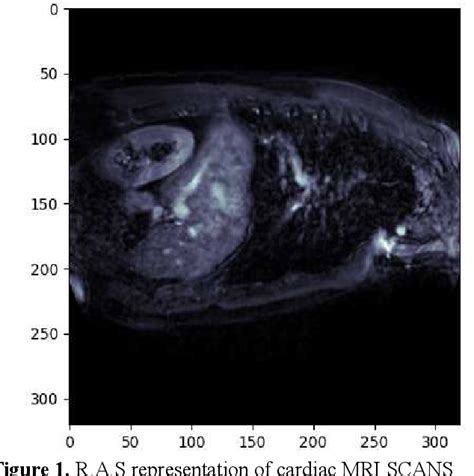 Figure 1 From Left Atrium Segmentation Using Deep Learning Model Semantic Scholar