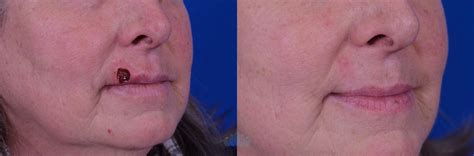 Skin Cancer Before And After Pictures After Mohs Skin Cancer Surgery