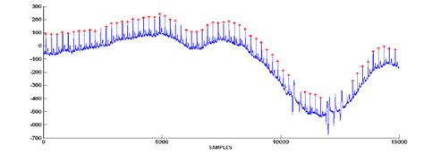 Qrs Detection Applied To 426mdat From Mit Bih Malignant Download