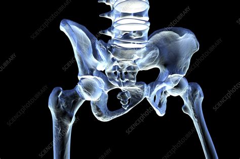 Subcapital Femur Fracture Illustration Stock Image F043 9259 Science Photo Library