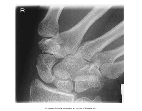 Pa Axial Scaphoid Radiograph Quiz