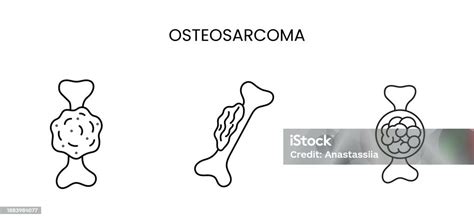 Cancer Osteosarcoma Line Icon Vector Cancer Malignant Disease Stock Illustration Download