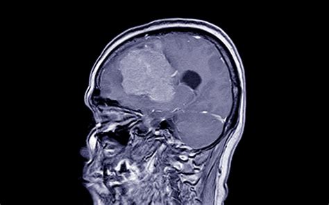 What Are The Causes Of Cerebral Edema