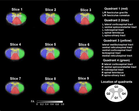 Binary Masks Of White Matter Quadrants Are Illustrated In Red Quadrant Download Scientific