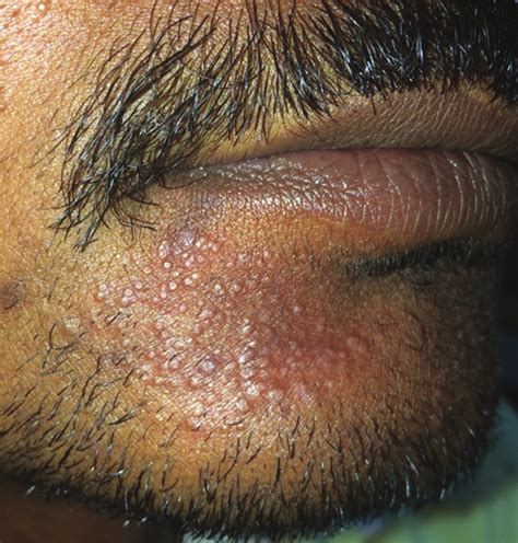 Multiple Grouped Papular Lesions On The Chin Download Scientific Diagram