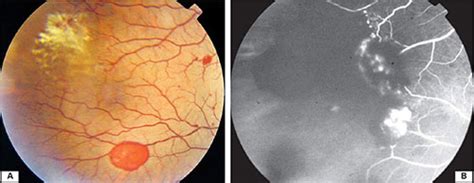 Sickle Cell Retinopathy Salmon Patch