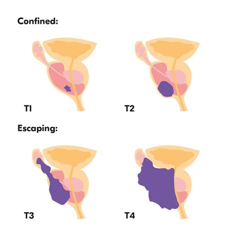 About Prostate Cancer Tackle Prostate Cancer